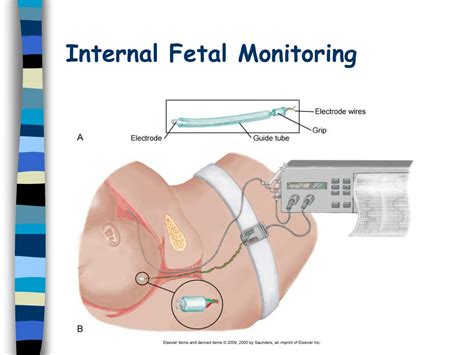 Ppt Fetal Monitoring Powerpoint Presentation Free Download Id3127064