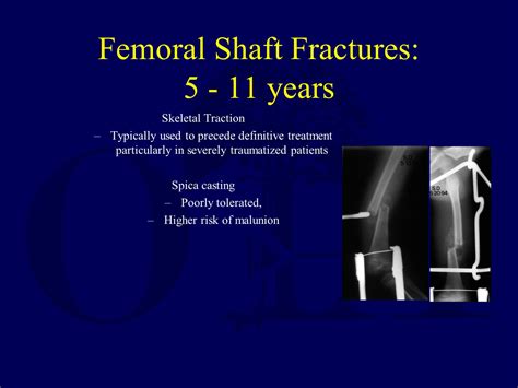 Skeletal Traction Femur Fracture