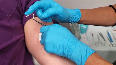 Implant Birth Control Removal