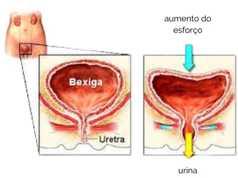 Incontinência Urinária Feminina Existe Solução Fisio Pélvica AKTALiv
