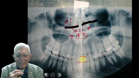 Bilateral Caved In Bicuspids Part 1 Youtube