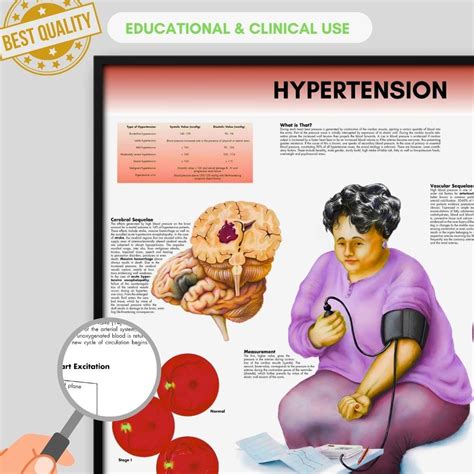Hypertension Poster Anatomy Human Biology Poster Medical Student Poster