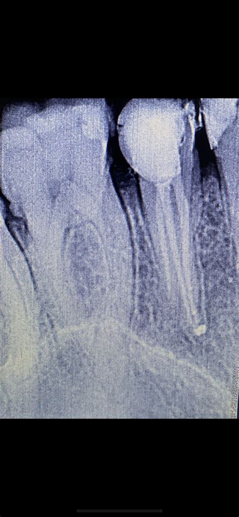 Modar Alshanaa On Linkedin Upper Premolar 3 Canals 🦷