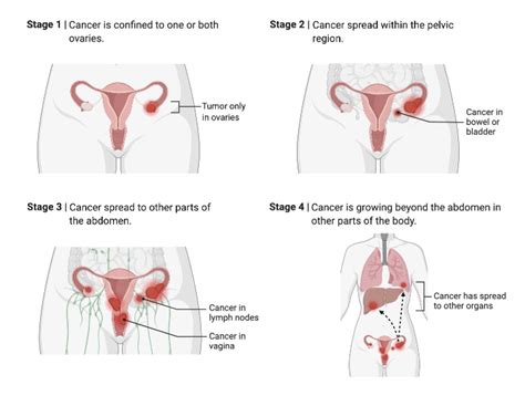 Ovarian Cancer Staging Biorender Science Templates