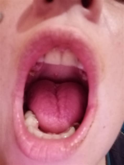 Горло Прыщ Вопрос лору 03 Онлайн