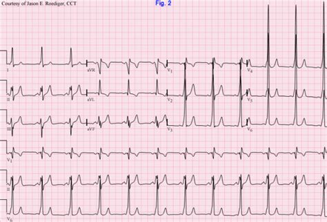 Accessory Pathway Ecg Guru Instructor Resources