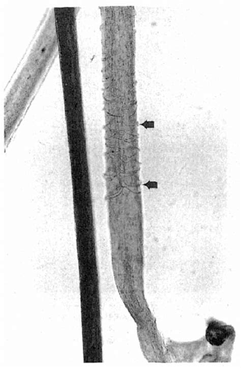 Normal Anagen Hair Has Lost Both Inner And Outer Root Sheaths During