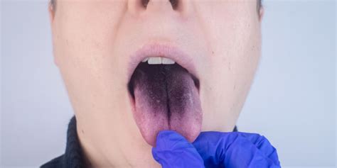 What Causes Dark Spots On The Tongue