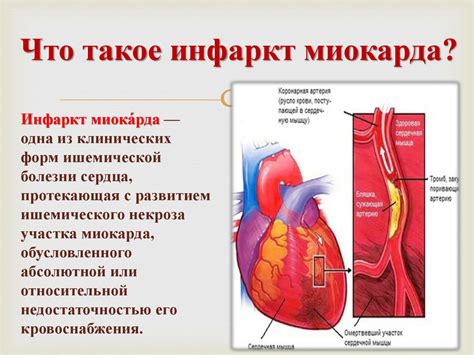 Инфаркт миокарда - online presentation