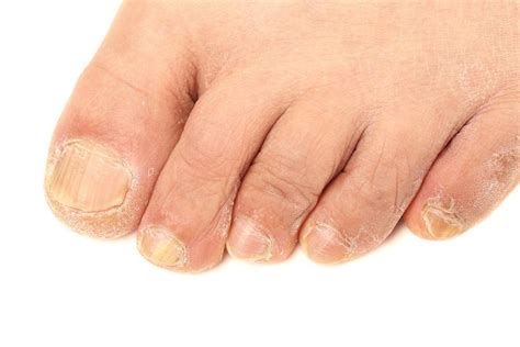 What Causes Toenail Fungus And How Can I Get Rid Of It Jennifer