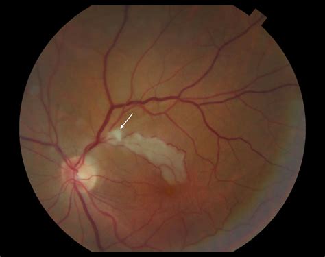 Moran Core Fundus Photography And Fluorescein Angiography Of Branch Retinal Artery Occlusion