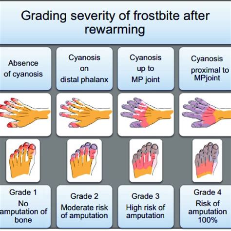 Grading Severity Of Frostbite And Bone Amputation Risk After Rewarming Download Scientific