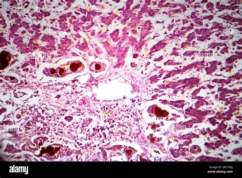 Histopathology Of Acute Severe Hepatitis Light Micrograph Photo Under
