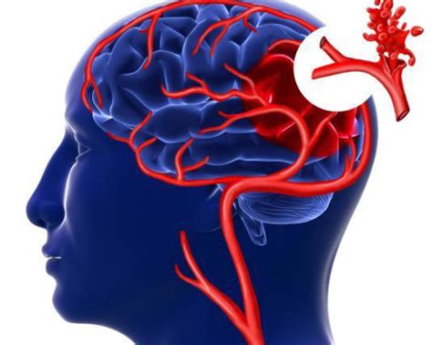 高血压千万别大意，警惕变成脑出血，做好这5个措施能预防