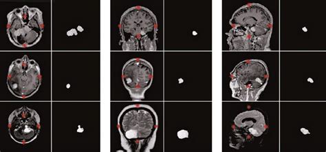 Automatic Segmentation Of Brain Tumors In Magnetic Resonance Imaging Einstein São Paulo