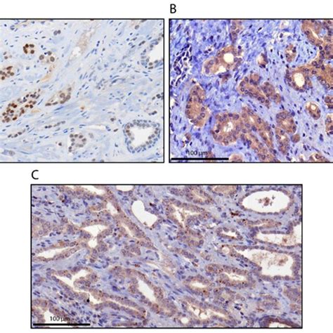Immunohistochemical Staining For Androgen Receptor Ar And Ar V7 A