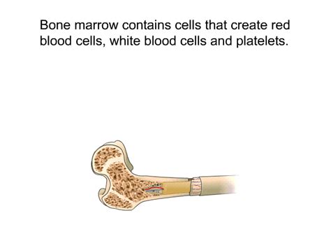 paget s disease of bone