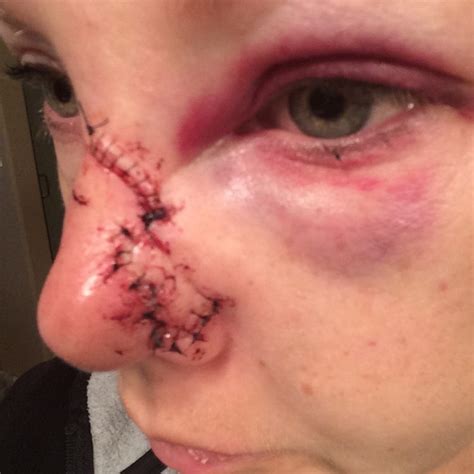 Photos Of Scab On Nose That Was Skin Cancer