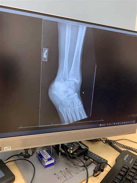 Broken Fibula And Partially Dislocated Tibia Rbrokenbones