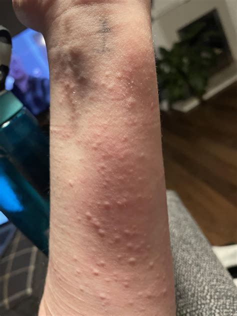Exercise Induced Urticaria Rurticaria