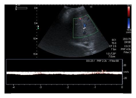 Spectral Doppler Image In A Patient With Bcs Shows Monophasic Waveform