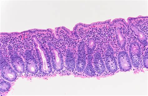 Pathology Outlines Autoimmune Enteropathy