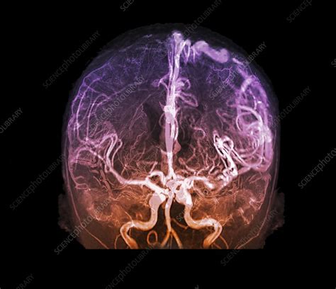 Cerebral Arteriovenous Malformation 3d Ct Scan Stock Image C038