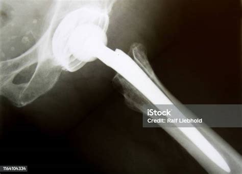 관절관절증을 가진 고관절의 X선 영상 X 레이에 대한 스톡 사진 및 기타 이미지 Istock