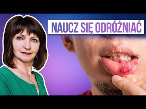 Dokuczliwe Afty I Zapalenie Jamy Ustnej Przyczyny Objawy Jak