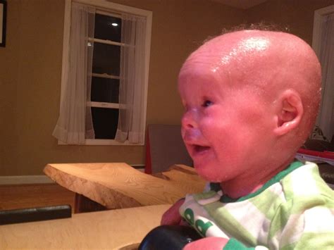 Harlequin Ichthyosis Survivor