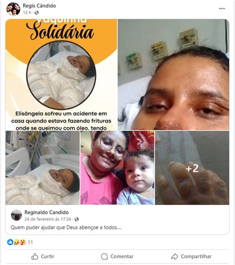 Mulher Se Queima Ao Fritar Ovo E Morre 10 Dias Após Internação Brasil