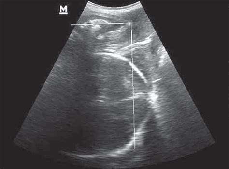 A Typical Itu Image Sagittal Cross Section Distance Of Progression
