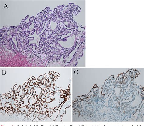 Figure 1 From Choroid Plexus Metastasis Of Follicular Thyroid Carcinoma