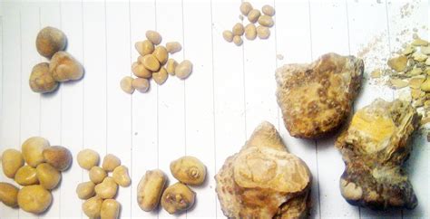 Виды камней в почках фото и описание плотность и способы лечения