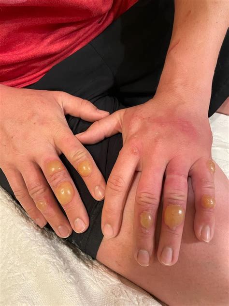 [sun Care] Psa Lime Juice Can Make You Extremely Sensitive To The Sun