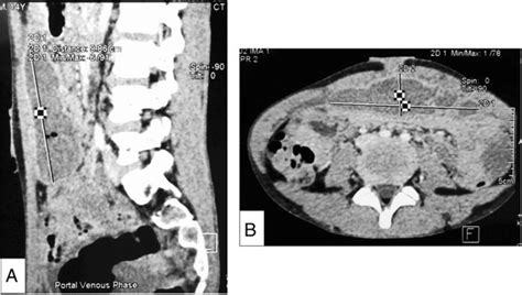 Computed Tomography Scan Of Abdomen Showing The Urachal Abscess A