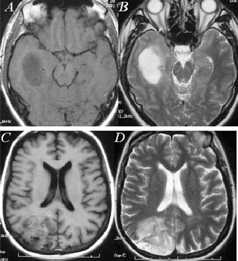 Mri Characteristics Of Oligodendroglial Tumours A And B Download Scientific Diagram