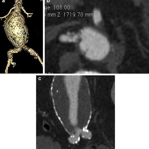 A 6 5 Cm Juxtarenal Abdominal Aortic Aneurysm With Caudally Angulated