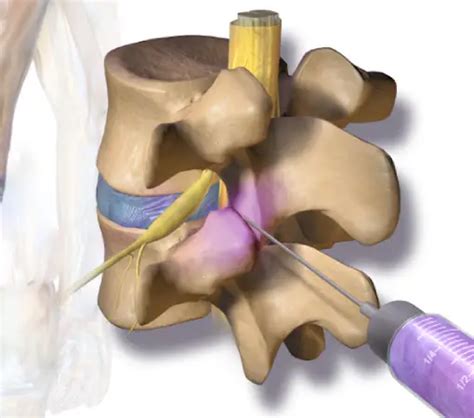 Facet Block Root Block Synapse Spine