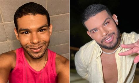 Ximbinha Mostra Antes E Depois De Cirurgia Facial Agora Tô Gatinho