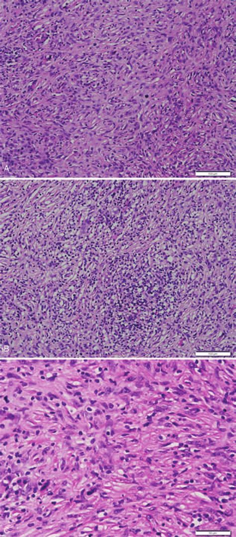 Histopathological Findings Of Follicular Dendritic Cell Sarcoma A