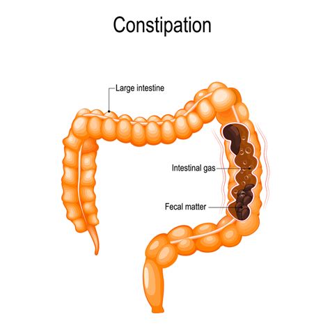 Constipation Treatments In Dubai Gastroenterology Department