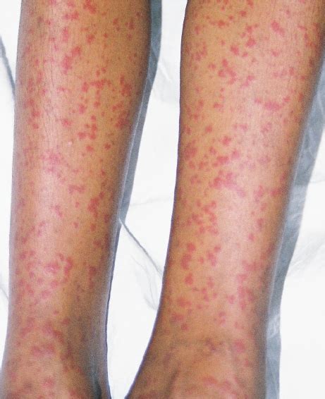 Name That Rash Quiz