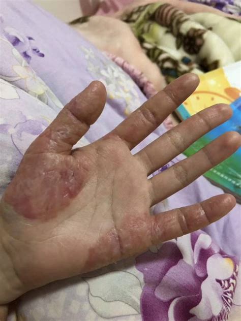 孩子撕手皮严重的图片 伤感说说吧
