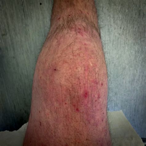 Quadriceps Tendon Rupture Recovery Phase 5 Swedanesdk