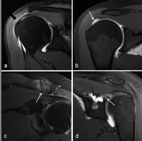 Sindromul De Impingement Al Umarului