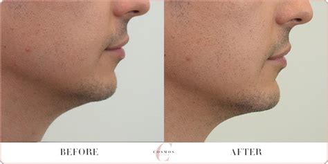 Chin Enhancement Before After Cosmos Aesthetics