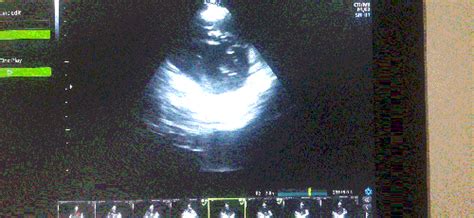 Non Ischemic Wall Motion Defect In Echocardiography Dr S Venkatesan Md