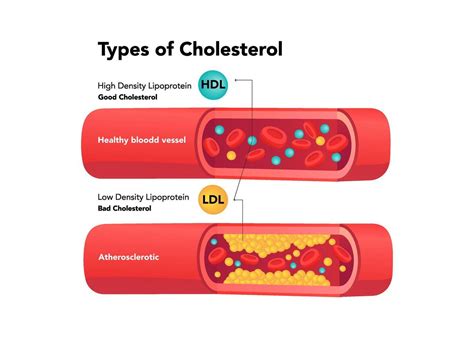 Tipos De Colesterol Comparación Con Hdl Y Ldl Valores Ilustración 73348726 Vector En Vecteezy