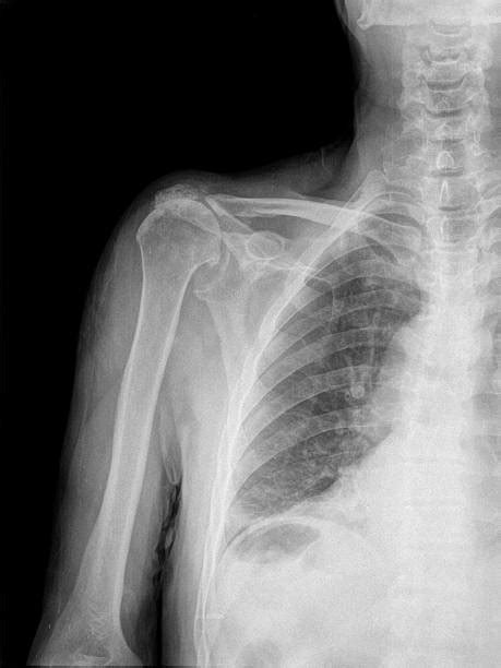 7300개 이상의 Shoulder X Ray 스톡 사진 그림 및 Royalty Free 이미지 Istock